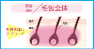 光脱毛のSHRとIPLの決定的な違い｜効果・回数・痛みまで丸わかり！
